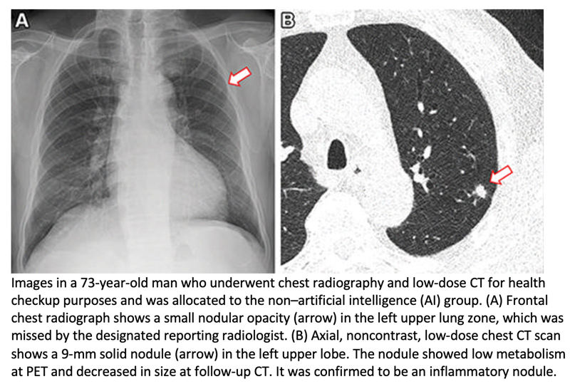 AI Improves Detection of Lung Nodules on Chest X-ray | Applied ... AI Improves Detection of Lung Nodules on Chest X-ray | Applied ...